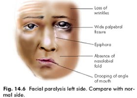 Healing Hands Physio Clinic & Slimming Centre: Facial Paralysis & The ...