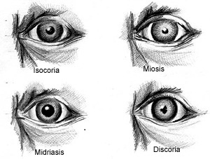 Diagnóstico diferencial de las alteraciones pupilares