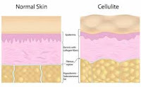 Penyebab Selulit | Lovely Blog