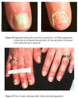 Nail Diseases: White Nails Disease