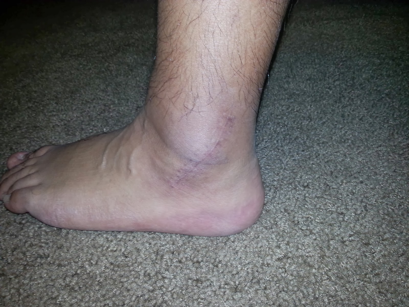 Peroneal Tendon Surgery Recovery: Ankle Time Line (updated for week 10/11)