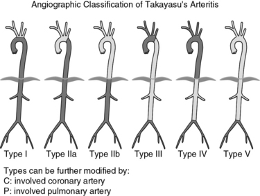 Medicina Interna y Reumatología: Arteritis de Takayasu / Sindrome ...