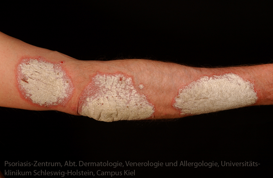 Psoriasis Vulgaris medical shaman