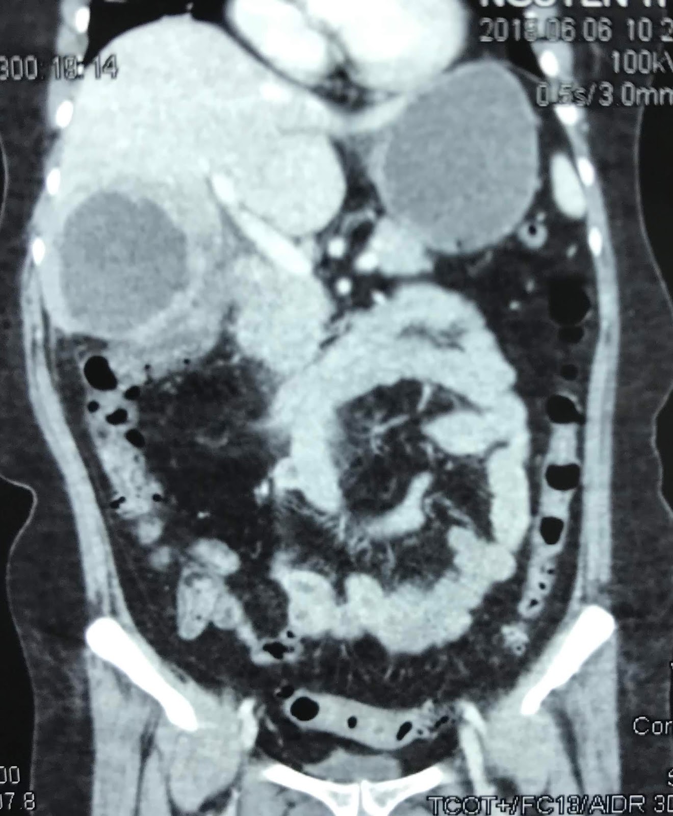 VIETNAMESE MEDIC ULTRASOUND: CASE 498: GALLBLADDER ABSCESS, Dr PHAN ...