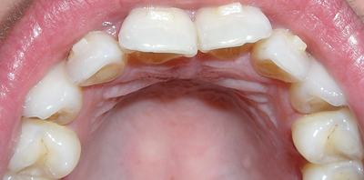 Sneek's Invisalign Treatment: Progress Weeks 17-18