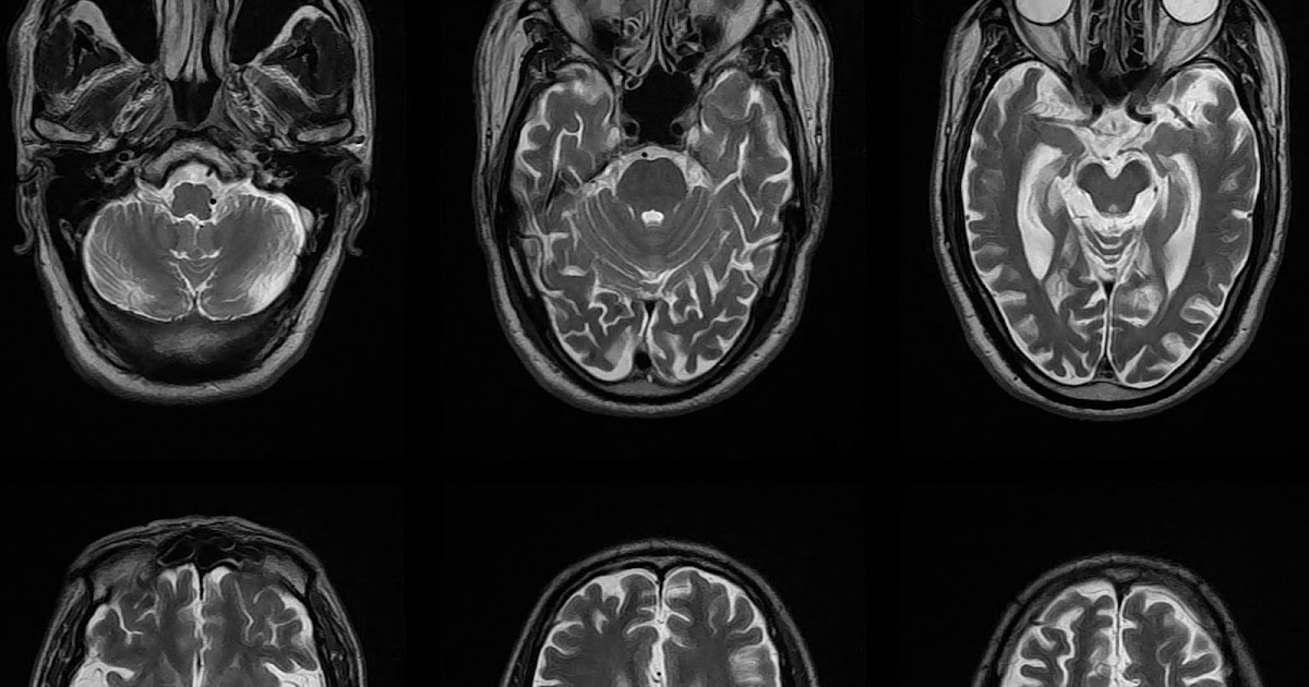 Dr Balaji Anvekar FRCR: Posterior cortical atrophy MRI