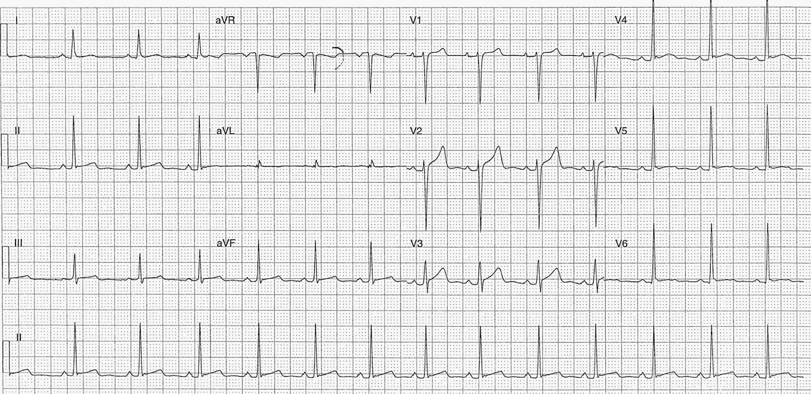 ECG of the Week: ECG of the Week - 12th October 2015