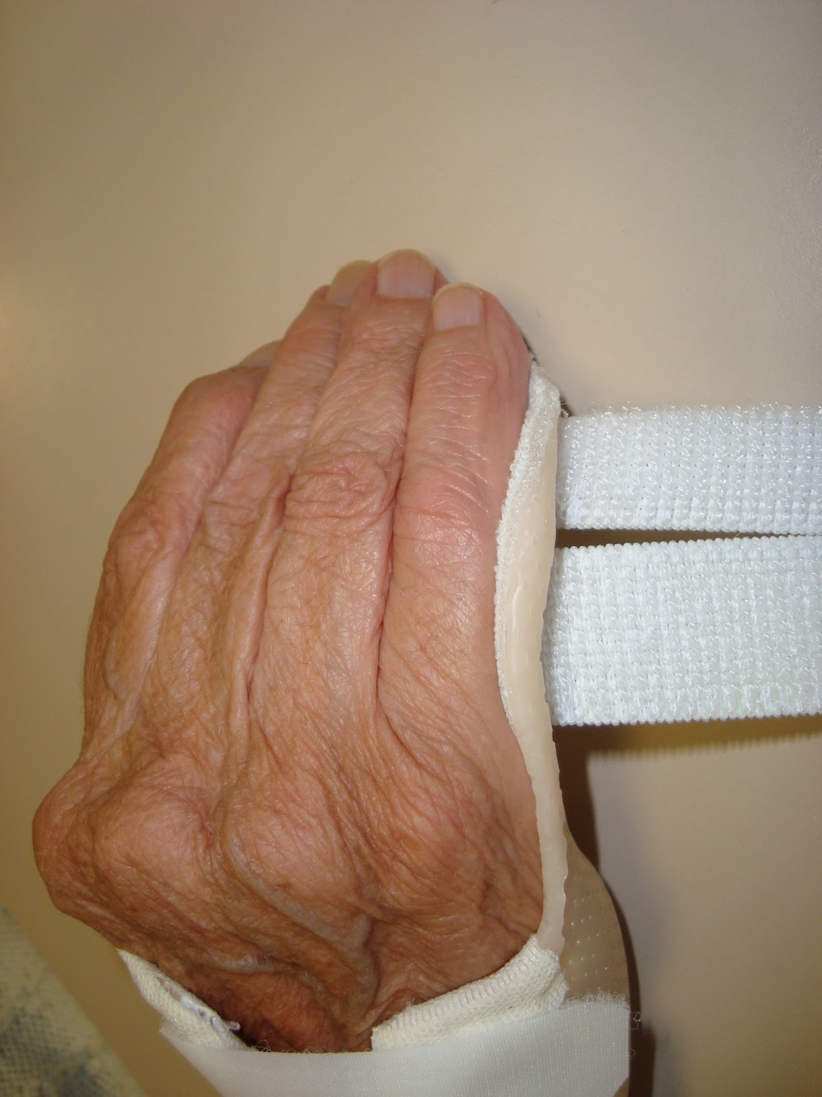 Orthèses sur mesure et appareillage personnalisé main poignet doigts ...