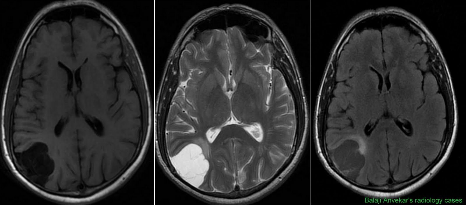 Dr Balaji Anvekar's Neuroradiology Cases: DNET MRI