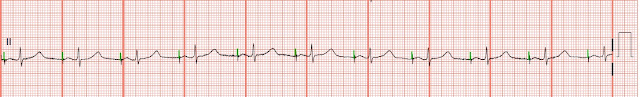 EKG Rhythm Strips 48