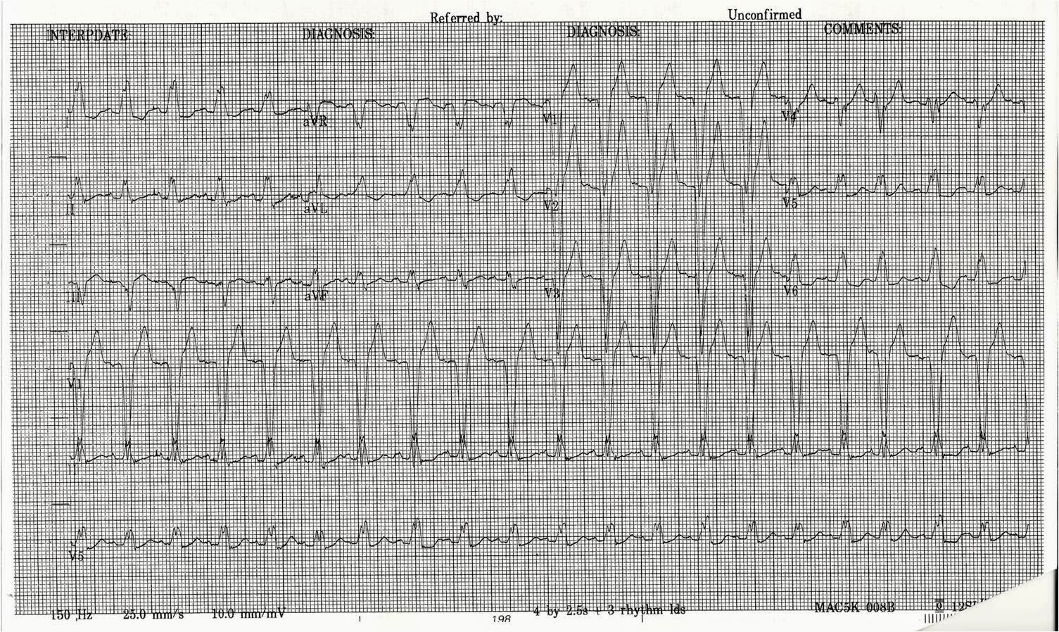 Dr. Smith's ECG Blog: June 2011