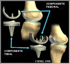 terapia postquirurgica: Caso Clinico "ARTROPLASTIA DE RODILLA"