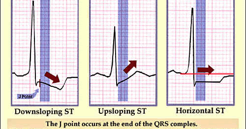 Simple Cardiology: - Types of ST segment depression in ECG.