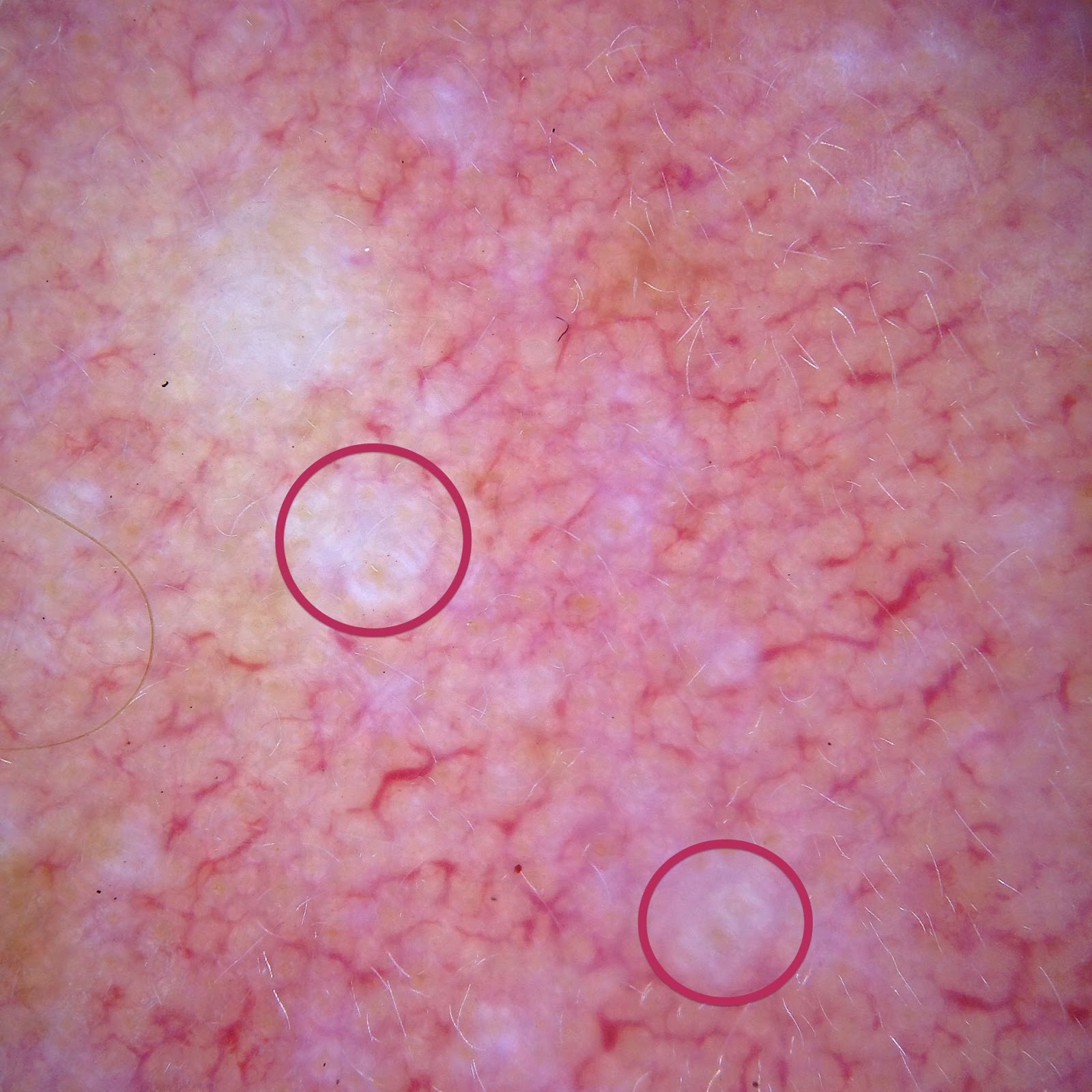 VIRTUAL GRAND ROUNDS IN DERMATOLOGY 2.0: Birt-Hogg-Dube Syndrome