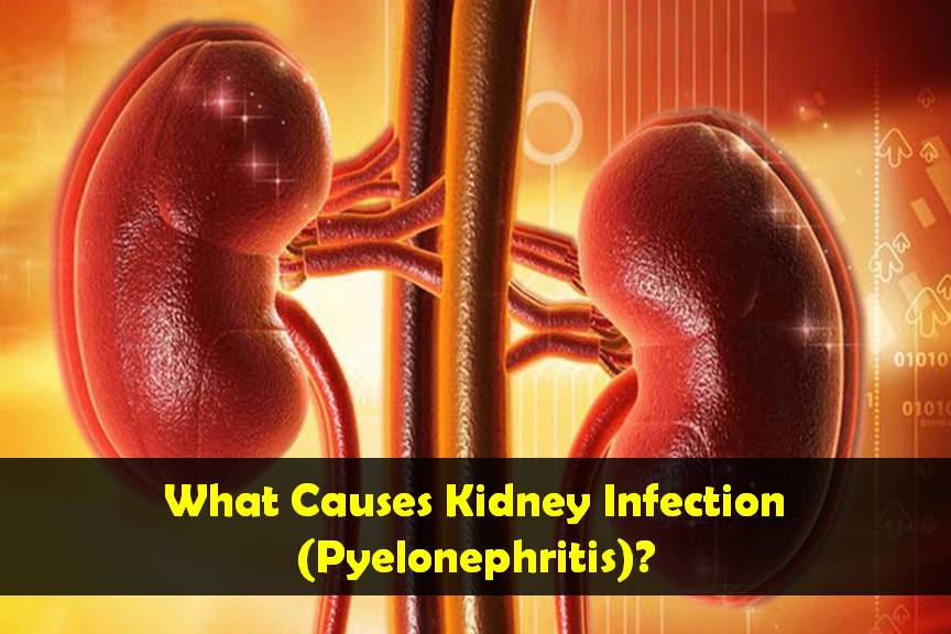 What Causes Kidney Infection (Pyelonephritis)?