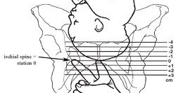 medical student: Bishop score