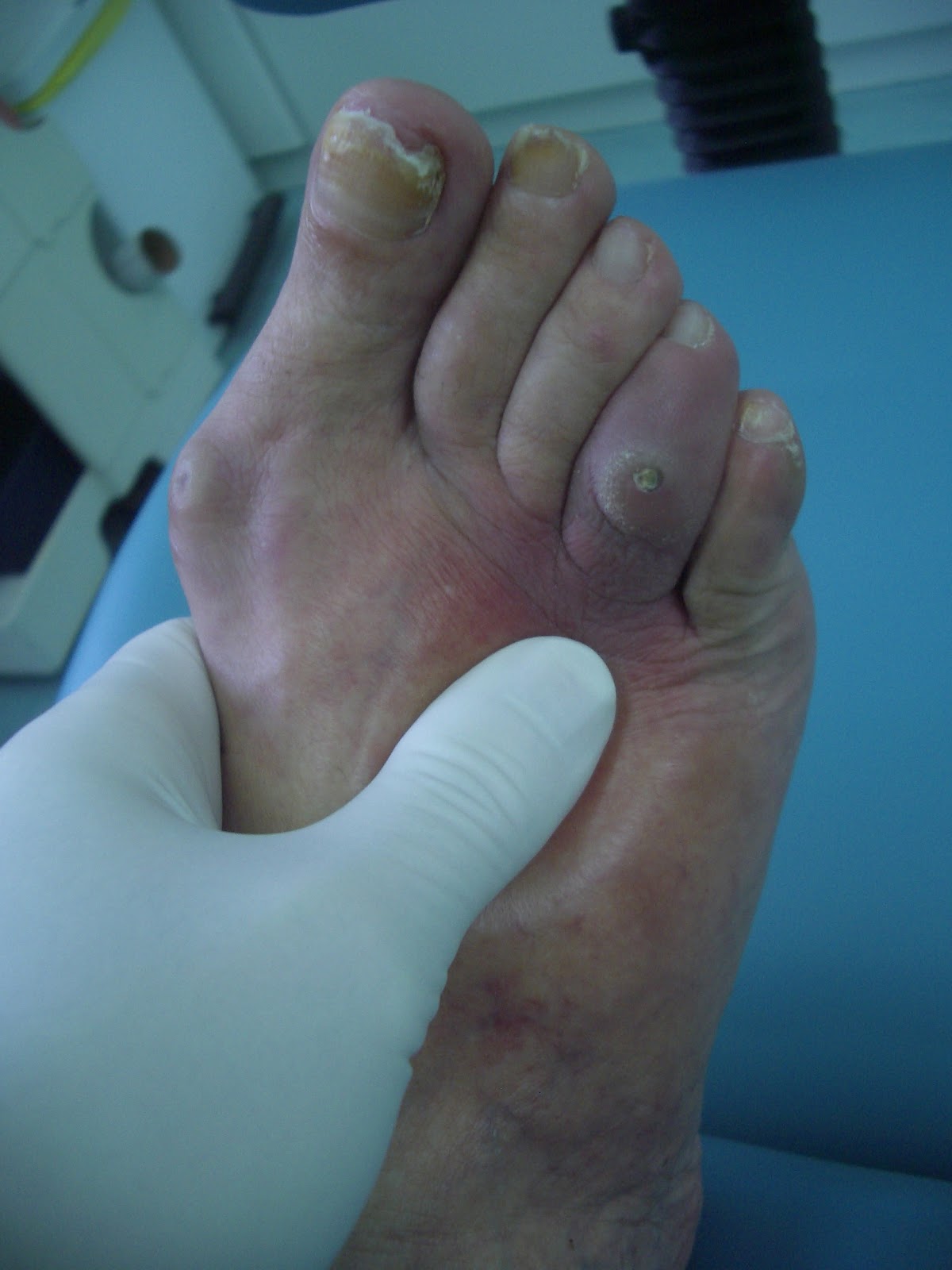 Podo Basas al Día: Infección con celulitis. Pies valgos. Dolor en ...