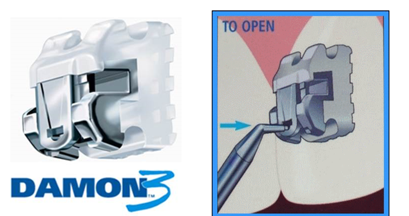 ORTOCEL: Evolución del bracket DAMON.
