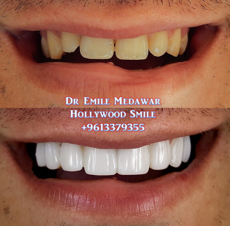 Hollywood Smile Lebanon, Beirut Dentist Dr Emile Medawar: Great ...
