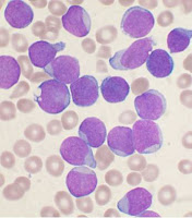 Faktor Penyebab Leukemia