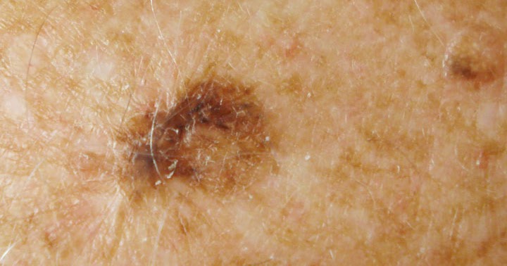 VIRTUAL GRAND ROUNDS IN DERMATOLOGY 2.0: Atypical Pigmented lesion in ...