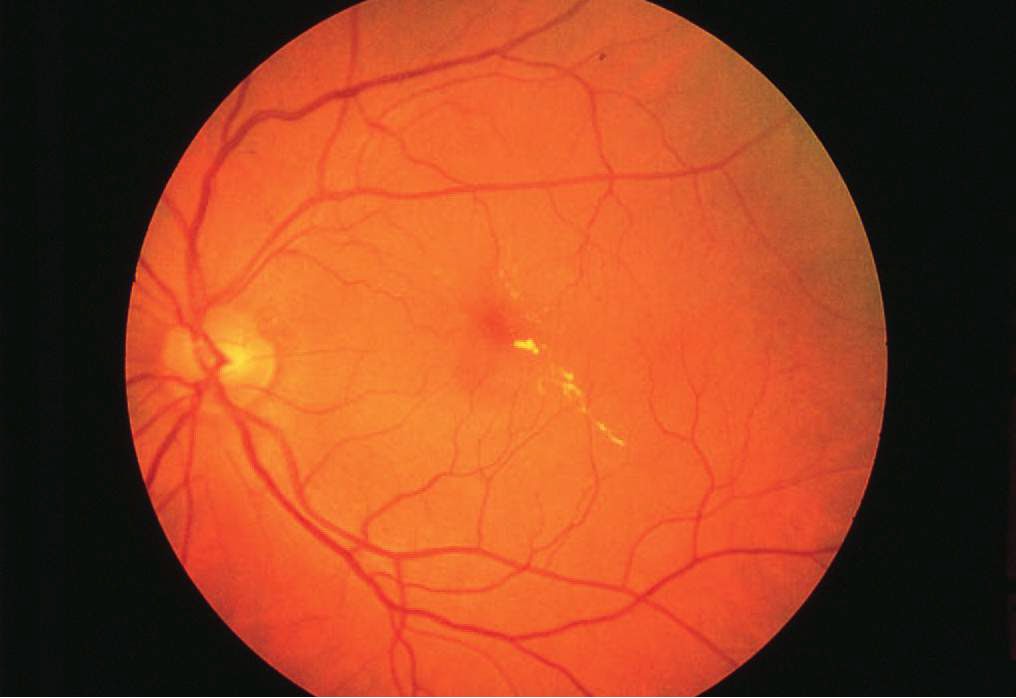 Study Medical Photos: Description Of Exudates As Seen On Fundoscopy