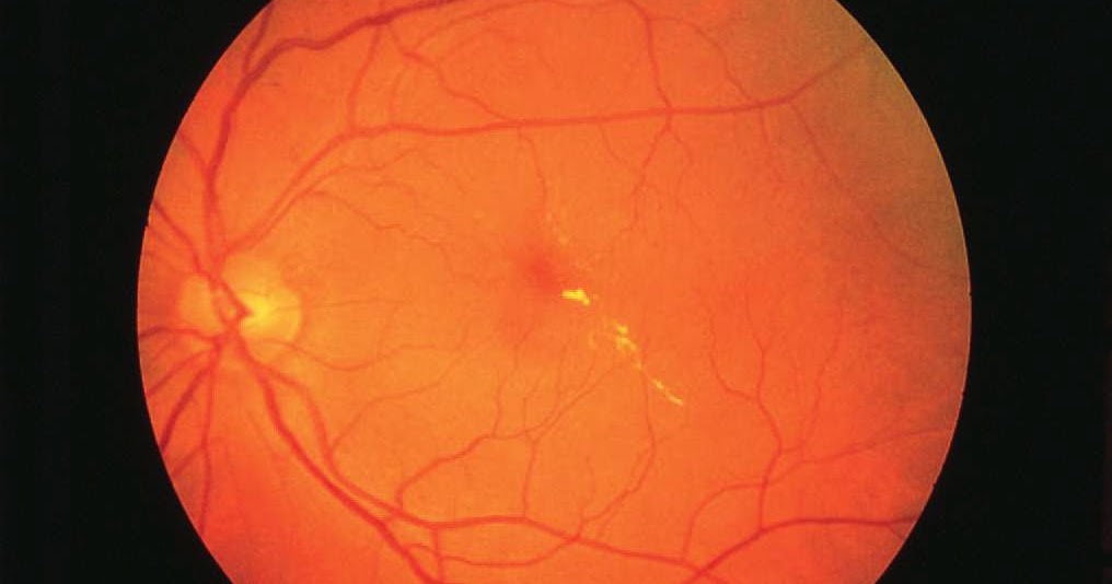 Study Medical Photos: Description Of Exudates As Seen On Fundoscopy