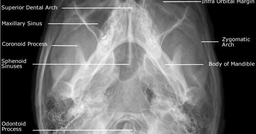 My Radiology Files: Occipito Mental 30° (OM30) View Anatomy