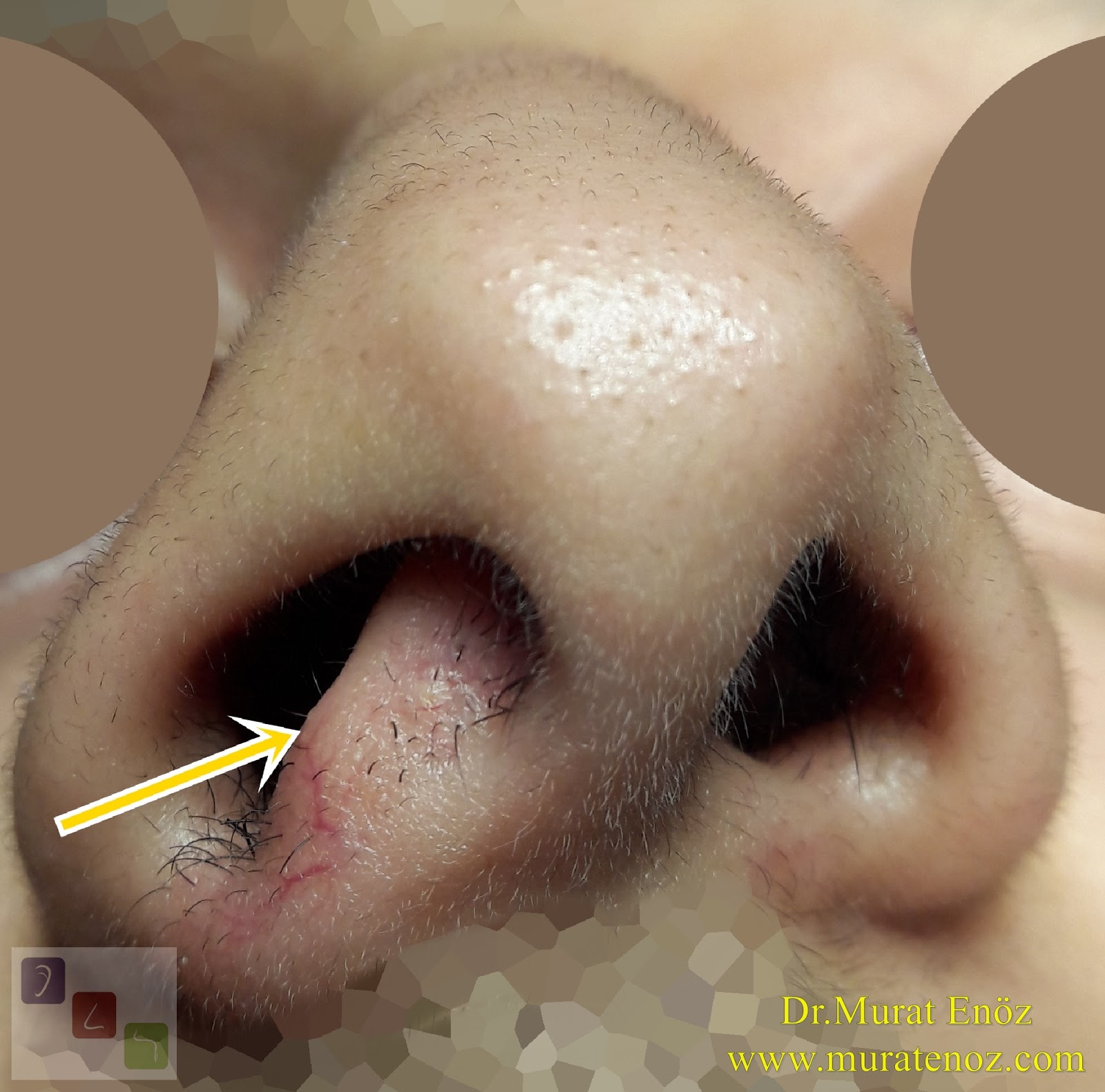 Caudal Septal Deviation