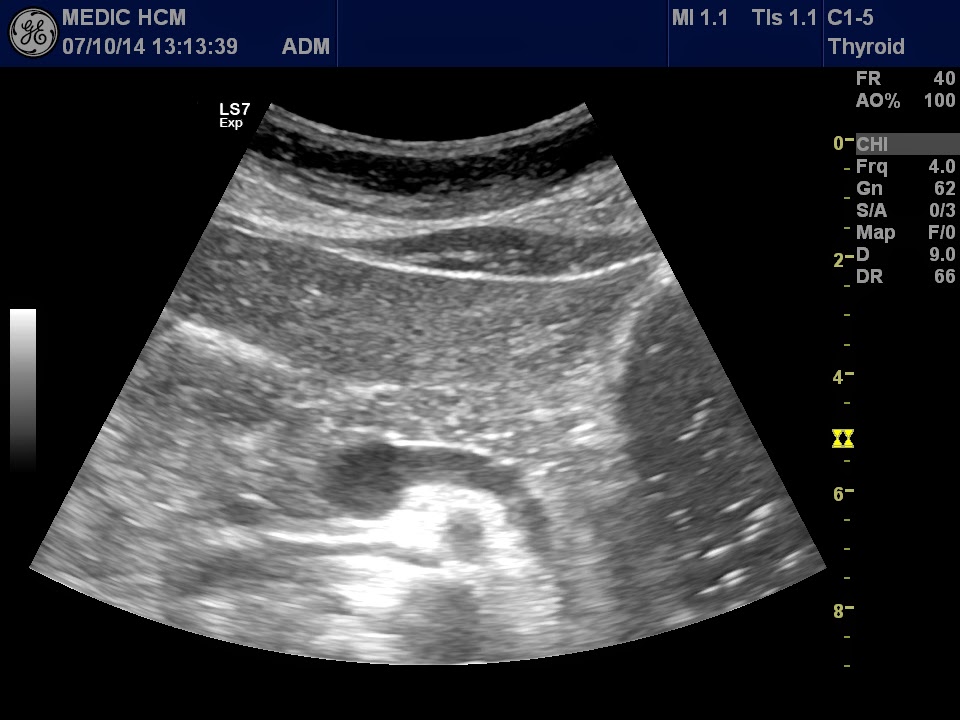 VIETNAMESE MEDIC ULTRASOUND: CASE 281: INSULINOMA, Dr PHAN THANH HẢI-Dr ...