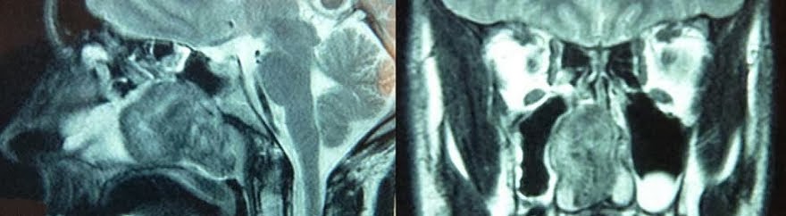 Otorrinolaringología Pediátrica: Timpanoplastia endoaural inlay con ...
