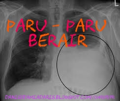 3D health beauty supplement: TESTIMONI VIVIX TERHADAP PENGIDAP PARU ...