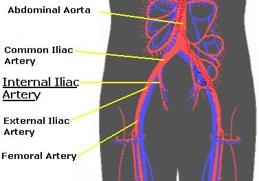 Iliac