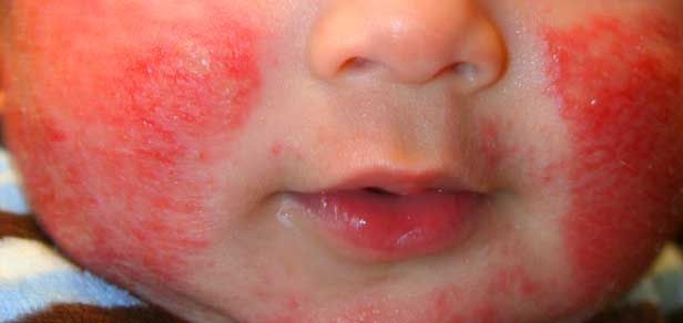 Psoriasis In Children: Treatment, Symptoms And Causes | Celebrities Funda