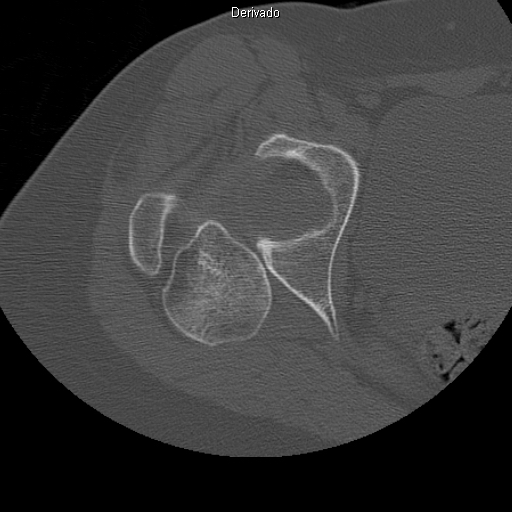 X-RAYview: Luxação da Anca
