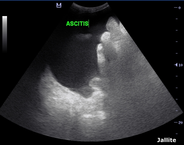 Cancer Hepatico & Ascitis Hematica