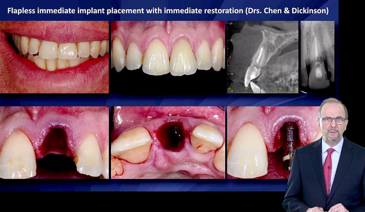 IMPLANTOLOGY: Implant Placement Post-Extraction in Esthetic Single ...