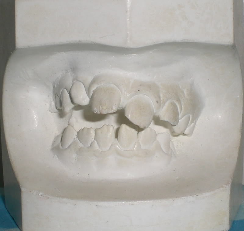 What Is Teeth Molding at Kevin Conger blog