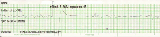 Float Nurse: ECG Rhythm Strip Quiz 85: Electrical interventions