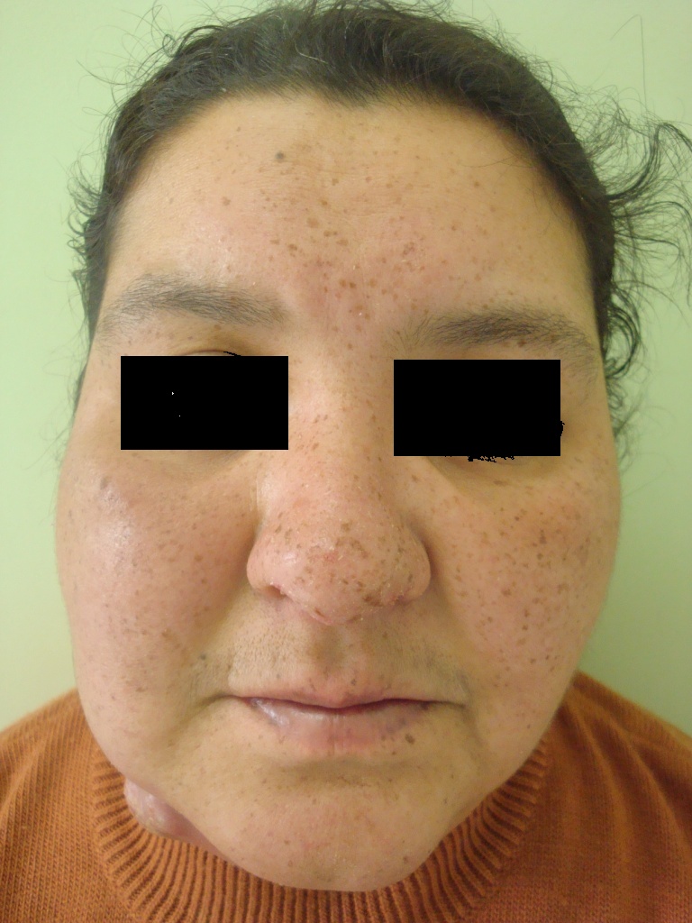 Abscesso - CIRURGIA BUCOMAXILOFACIAL