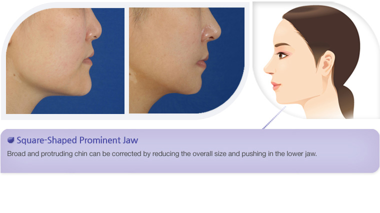 BK Plastic Surgery: [BK Plastic Surgery] Protruding Chin Correction
