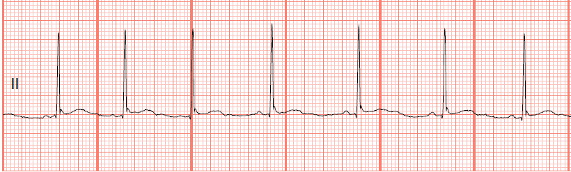 Basic EKG Rhythm Test 46