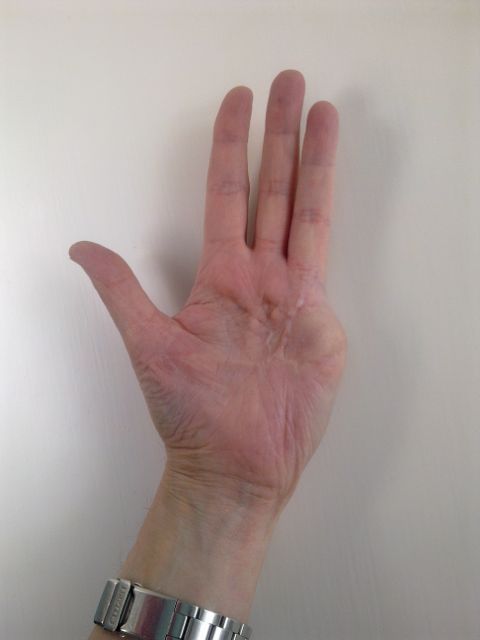 Handrehabilitationcase with Dupuytren's contracture.: A trauma in the ...