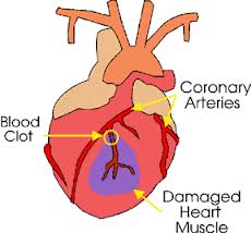 Heart Attack | Health