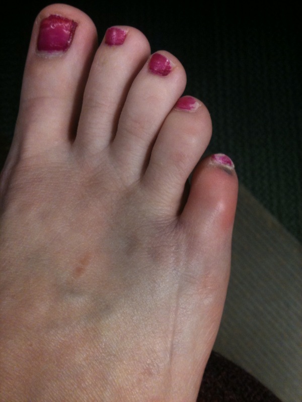 turbeillun: It's Been a Bad Year for Toes (Warning: Gross Pics)