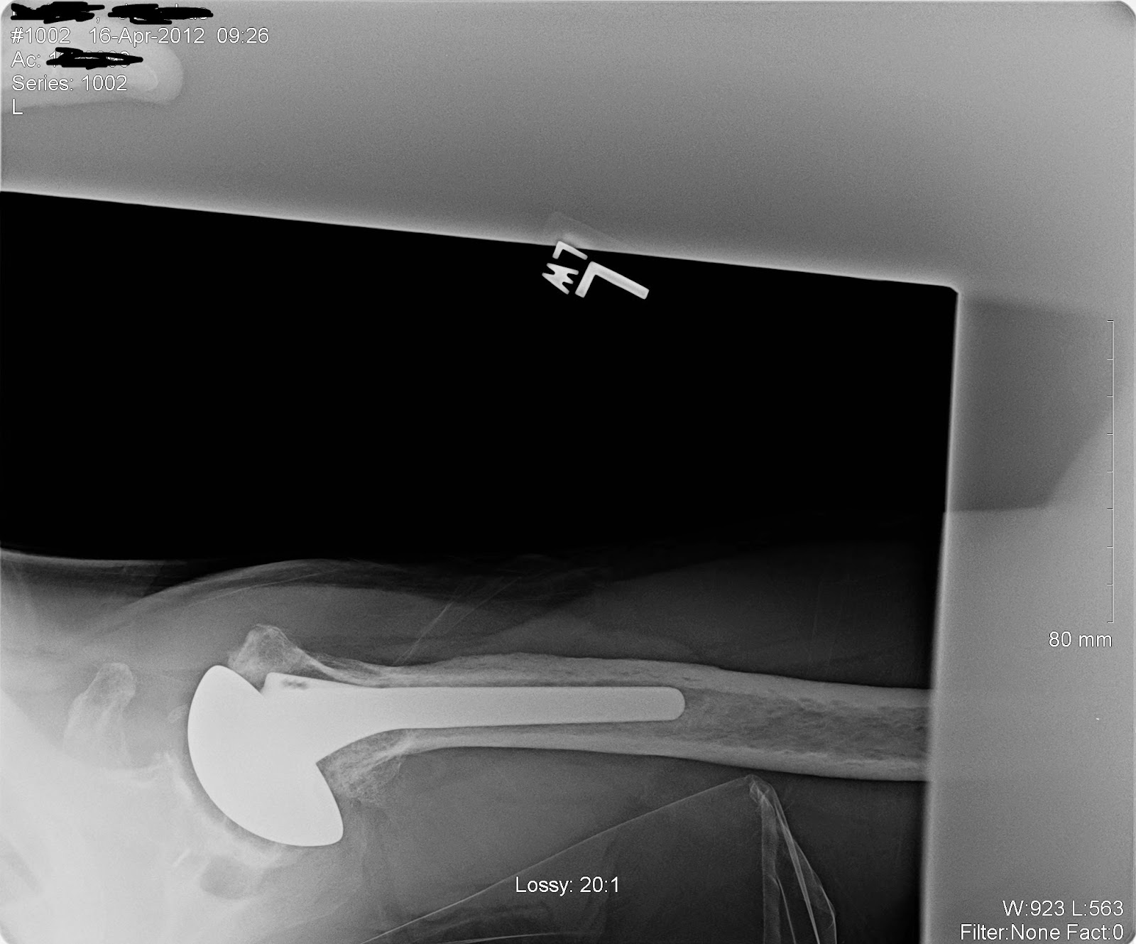 Shoulder and Elbow Surgery: The glenoid component in total shoulder ...