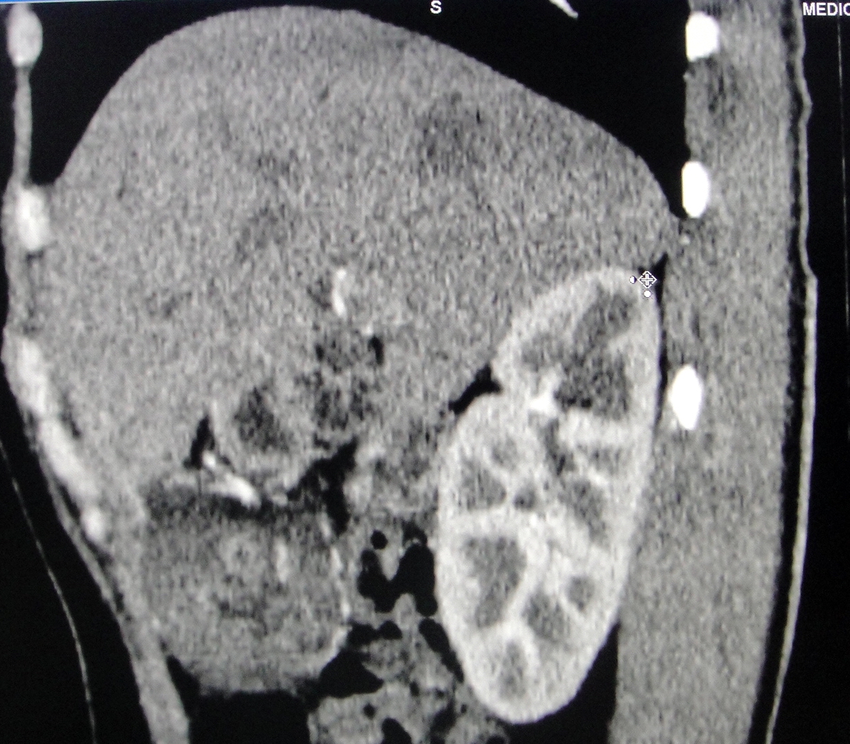 VIETNAMESE MEDIC ULTRASOUND: CASE 144: ABNORMAL GALL BLADDER, Dr PHAN ...