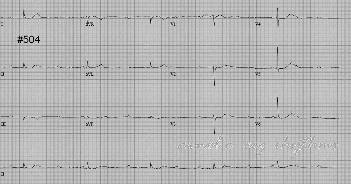 ECG Rhythms: Complete Heart Block