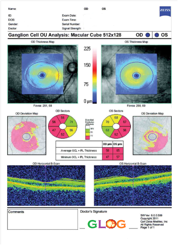 GLAUCOMA SPECIALIST BLOG: "THE GLOG"