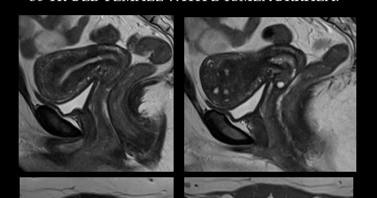 Ultimate Radiology : Adenomyosis of Uterus